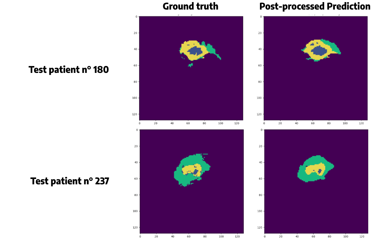 Image segmentation: Train a U-Net model to segment brain tumors ...